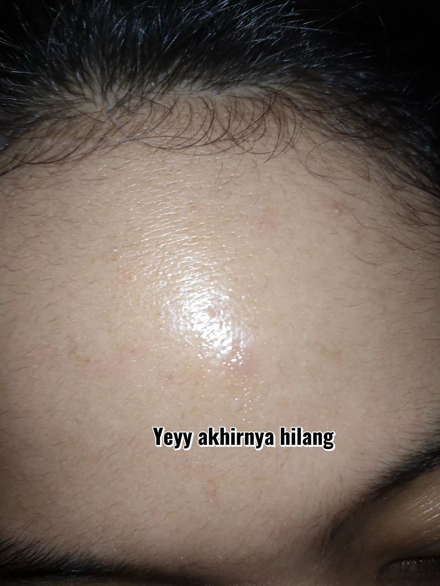 JERAWAT dan Bekas Jerawat Hilang | Galeri diposting oleh muty | Lemon8