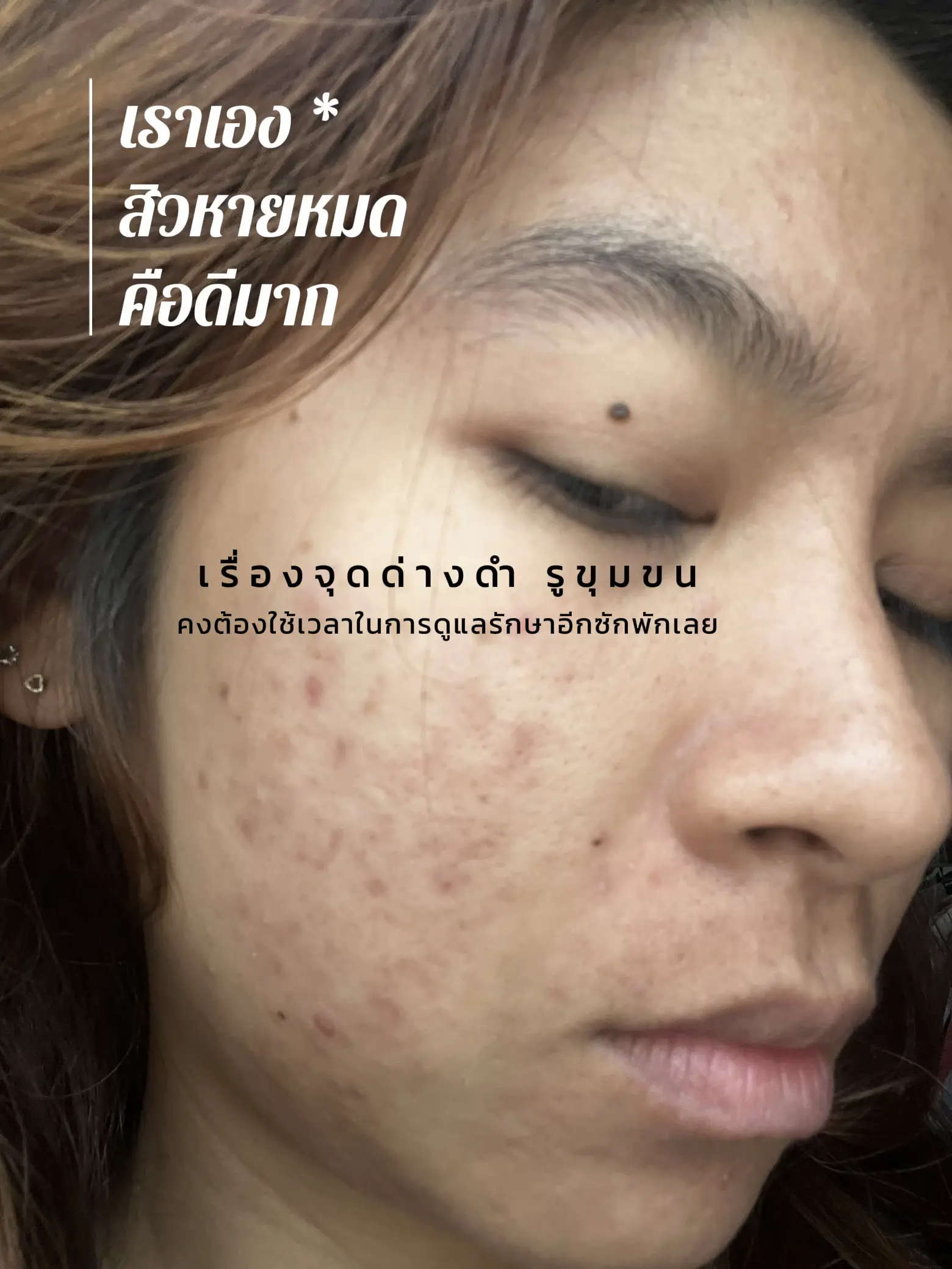 Review การใช้ Retinol แบบของแทร่ | แกลเลอรีที่โพสต์โดย ไม่กินหมู🐷 | Lemon8