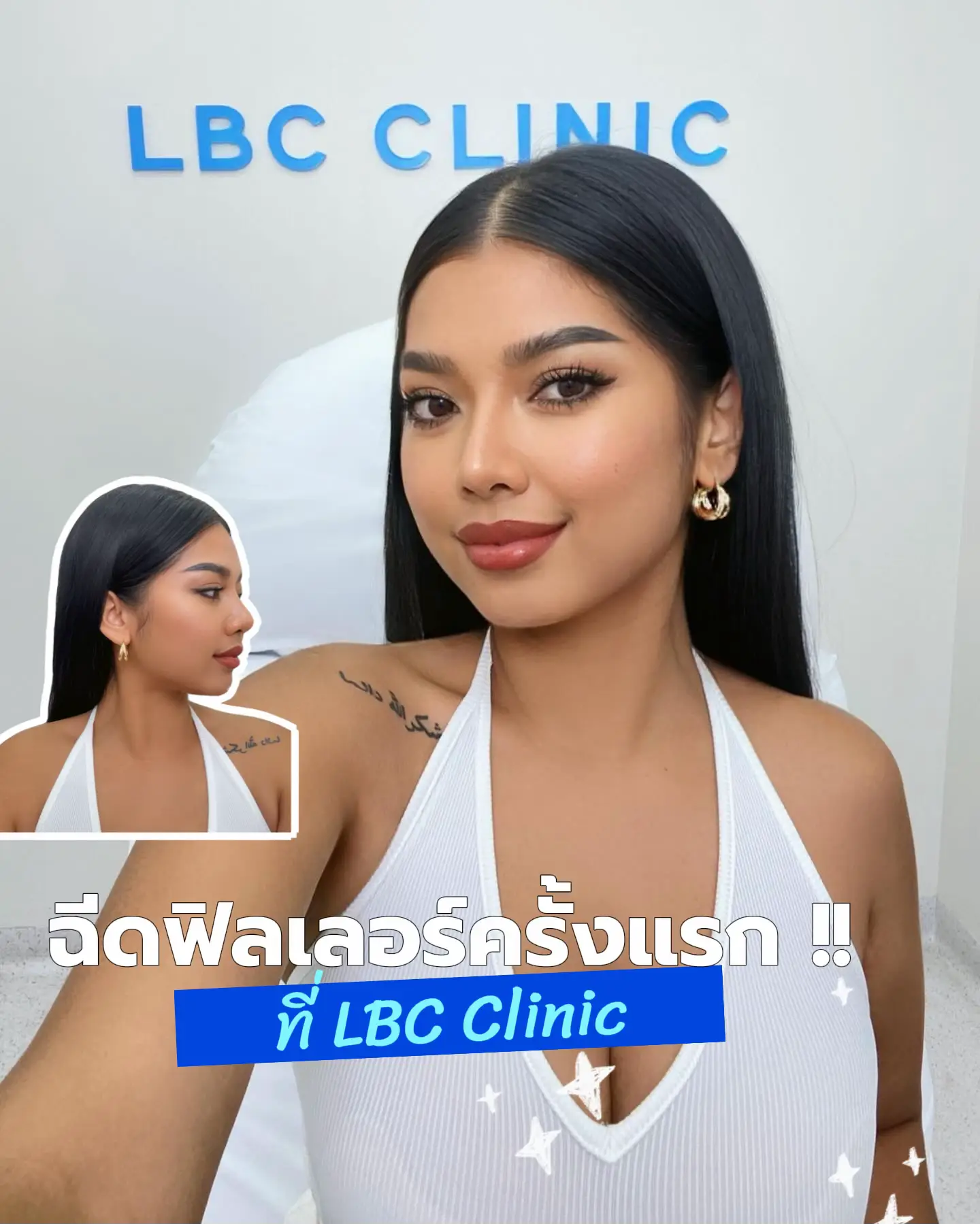 รีวิวฉีดฟิลเลอร์คางครั้งแรก ที่ LBC Clinic | แกลเลอรีที่โพสต์โดย Bebeysarah | Lemon8
