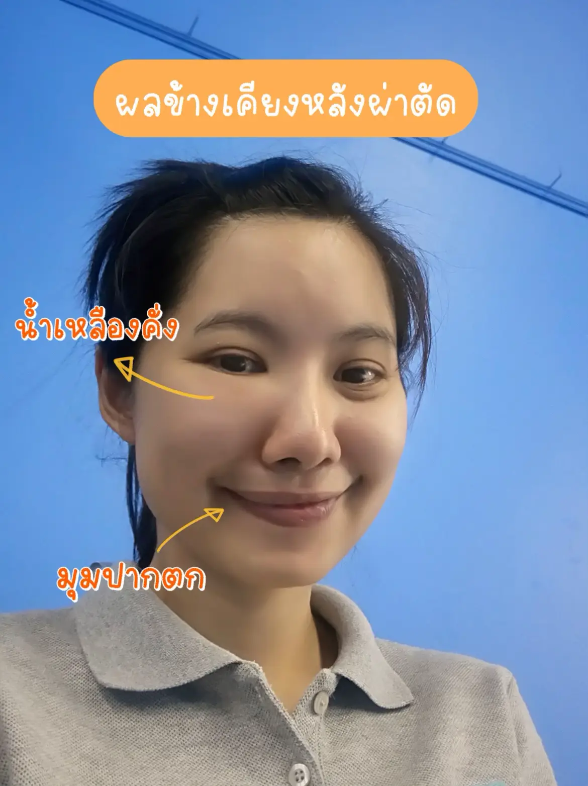 ประสบการณ์เป็นมะเร็งตอนอายุ 24 💪 | แกลเลอรีที่โพสต์โดย khuncha | Lemon8