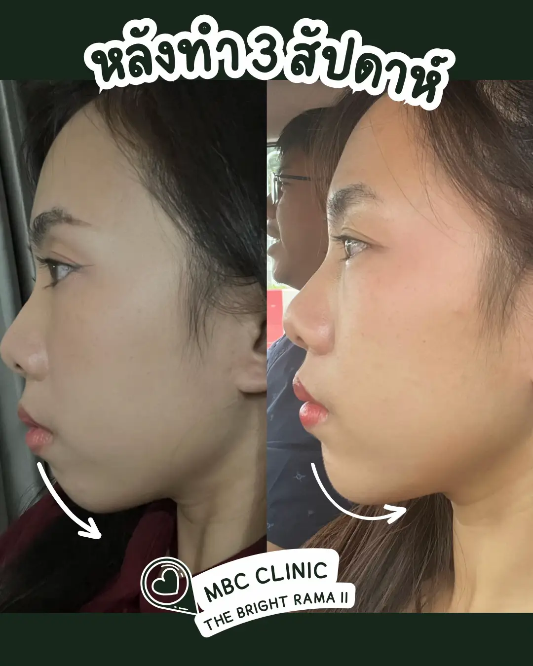 รีวิวฟิลเลอร์ E.P.T.Q | แกลเลอรีที่โพสต์โดย Sa Thananchamon | Lemon8