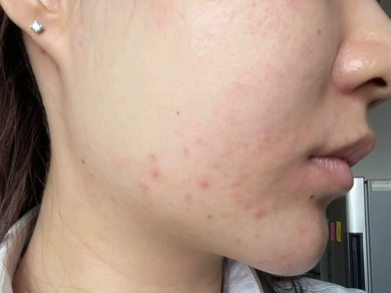 กู้ผิวเป็นสิว ผิวใส ฉบับผิวแพ้ง่าย | แกลเลอรีที่โพสต์โดย Cookiee | Lemon8