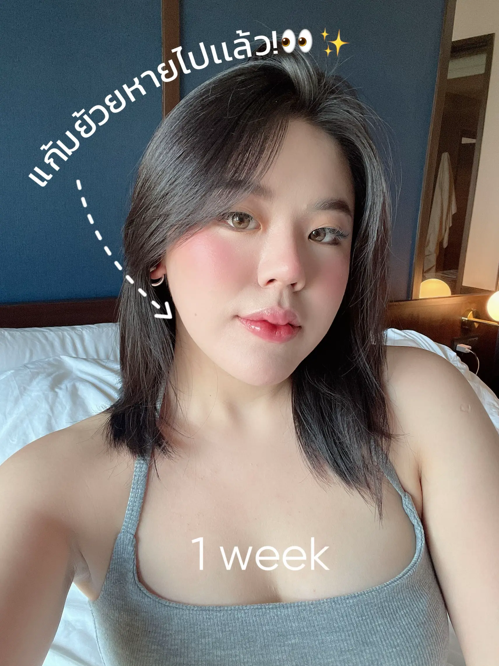 Face Check ep.1 ฉีดแฟตไม่เคยเห็นผลจนมาเจอตัวนี้ | แกลเลอรีที่โพสต์โดย BIBI 🧚🏻‍♀️ | Lemon8