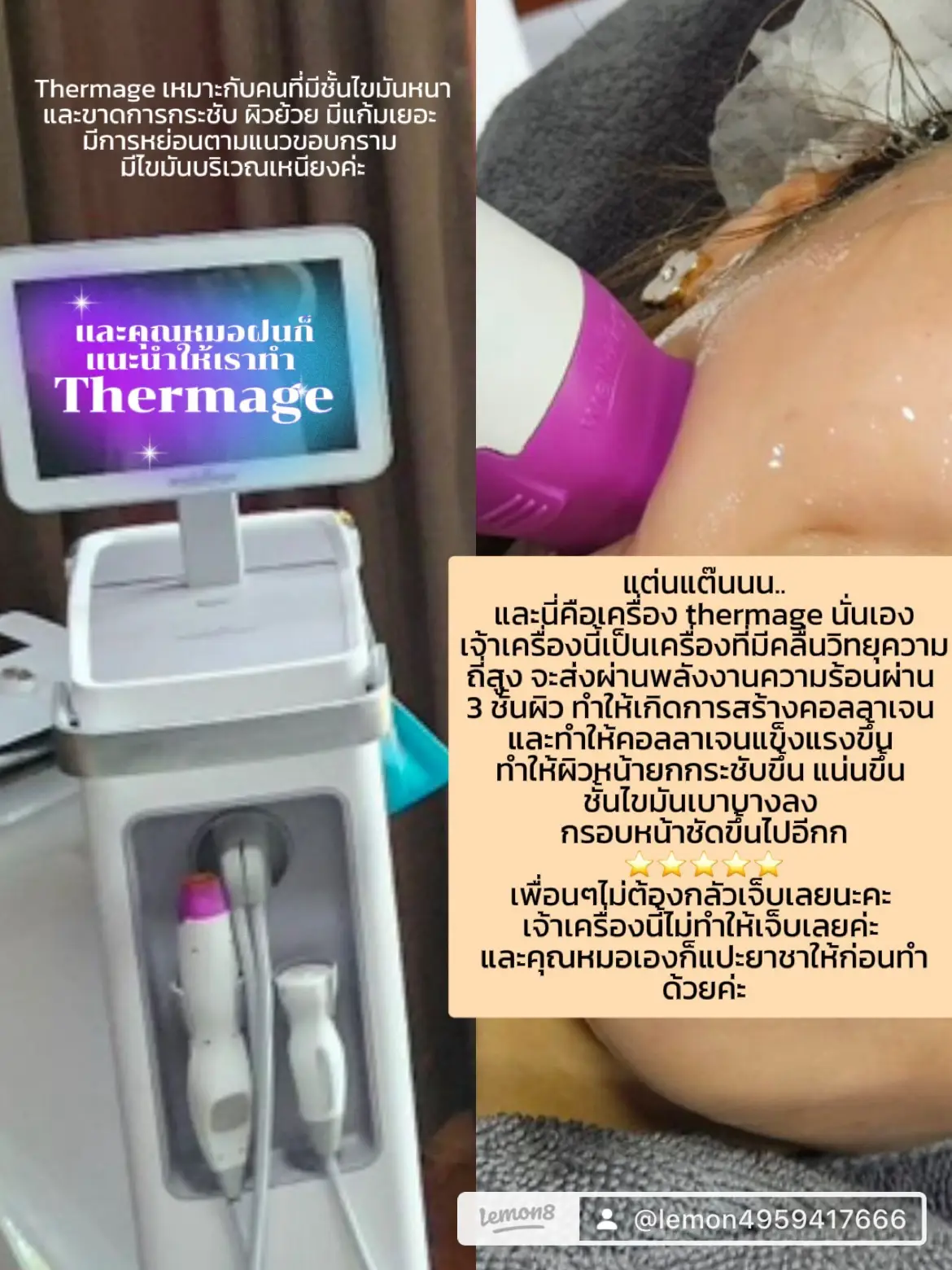 รีวิว ประสบการณ์การทำ Thermage หน้าเรียวเล็ก ยกกระชับผิวแน่น | แกลเลอรีที่โพสต์โดย Pla2Mackerel ...
