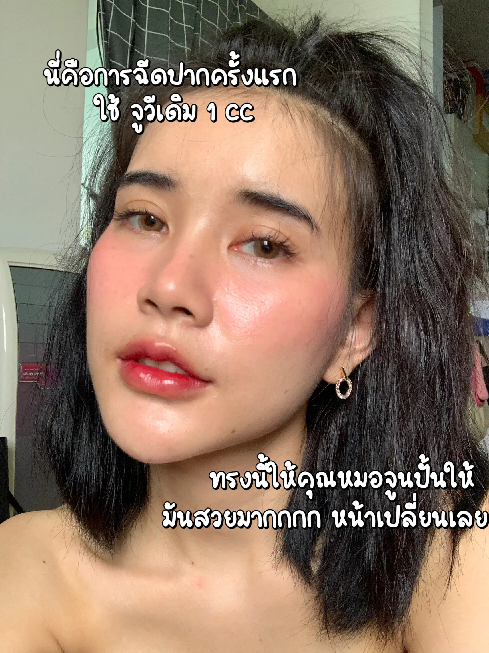 ฟิลเลอร์ปาก สวยจึ้ง ที่ classy clinic | แกลเลอรีที่โพสต์โดย Preempearploy | Lemon8