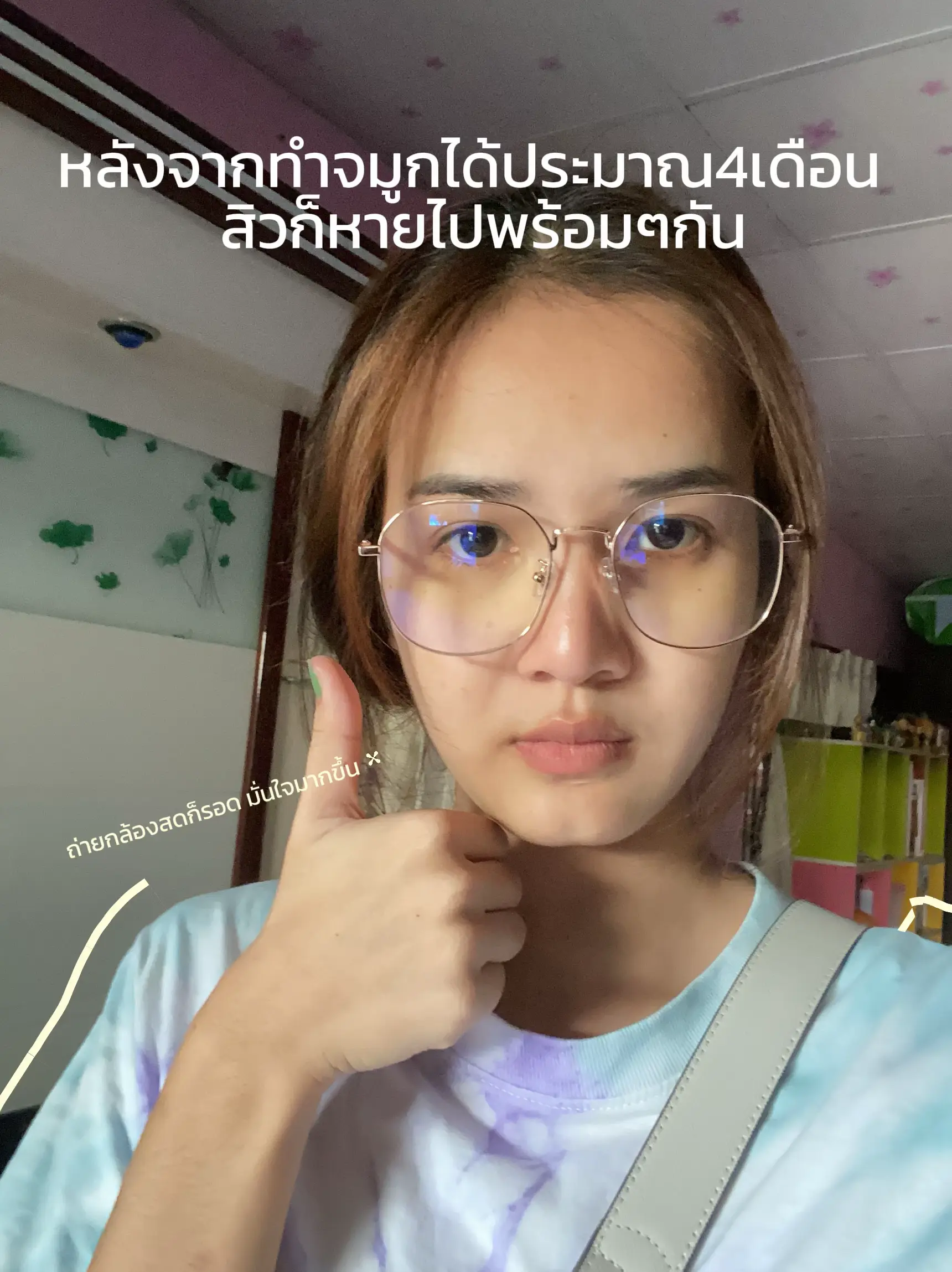 รีวิวศัลยกรรมครั้งแรก+รักษาสิว💊👃🏻🩸 | แกลเลอรีที่โพสต์โดย kanphitcha | Lemon8