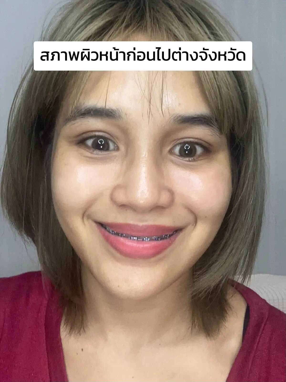 แชร์ประสบการณ์สิวเชื้อรา เลวร้ายที่สุดในชีวิต จิตตกมาก ⁉️ แกลเลอรีที่โพสต์โดย Pairyyyp Lemon8