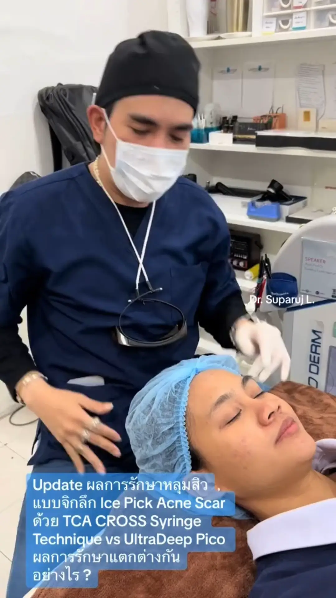 TCA CROSS Syringe Technique vs UltraDeep Pico | วิดีโอที่เผยแพร่โดย หมอรุจชวนคุยRuj | Lemon8