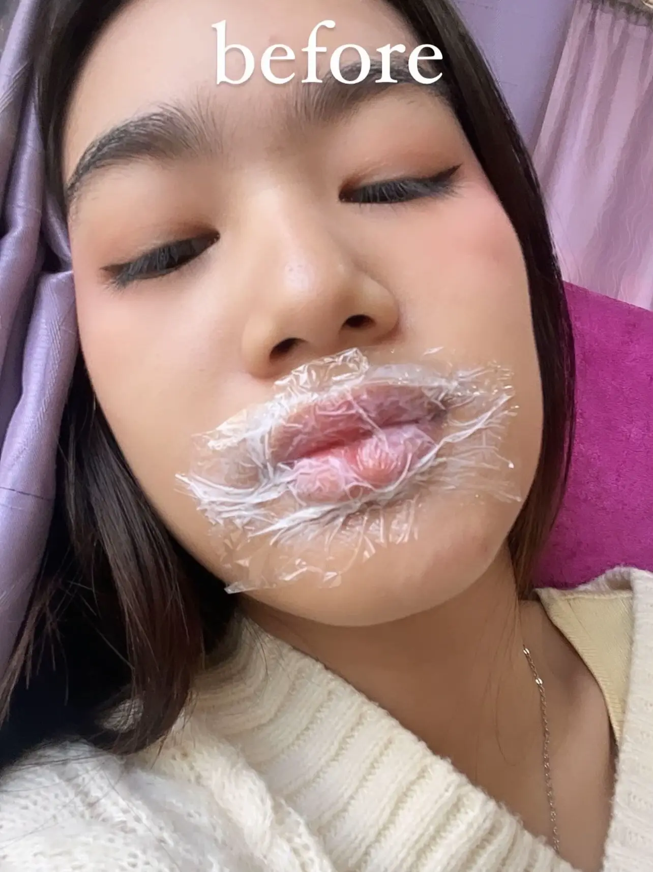 ฉีดปากครั้งแรก เจ็บมาก!😭 | แกลเลอรีที่โพสต์โดย Fern | Lemon8