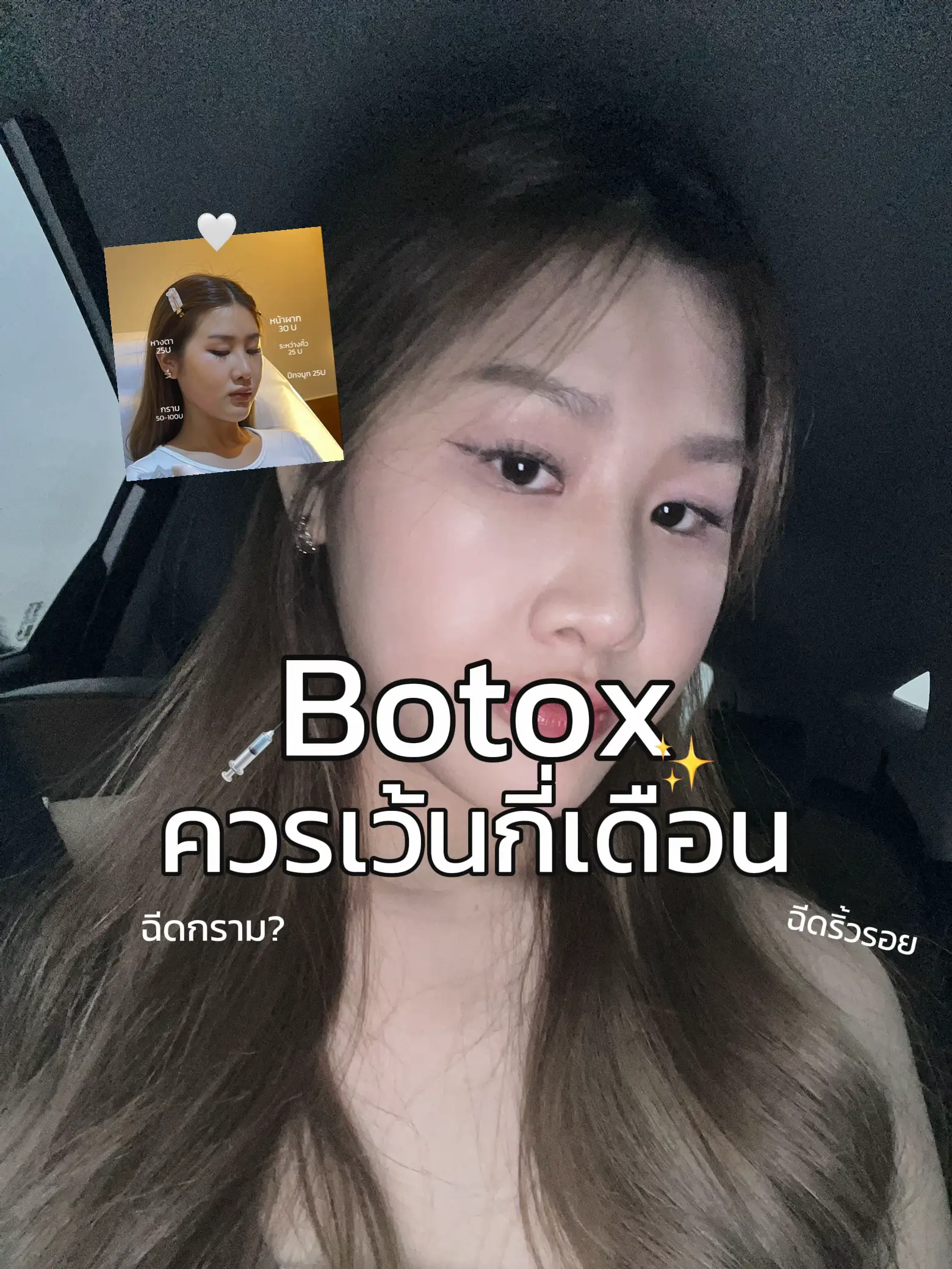 Botox ห่างกันกี่เดือน | 2024 ประสบการณ์ผู้ใช้จริงบน Lemon8
