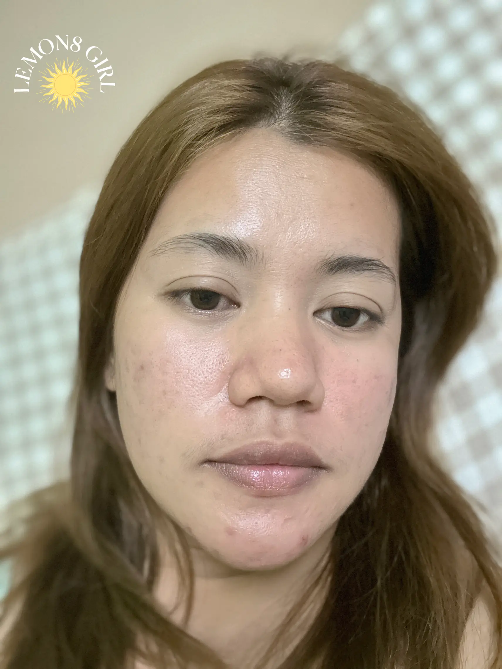 รักษาสิวด้วยสมุนไพร | แกลเลอรีที่โพสต์โดย NI NG | Lemon8