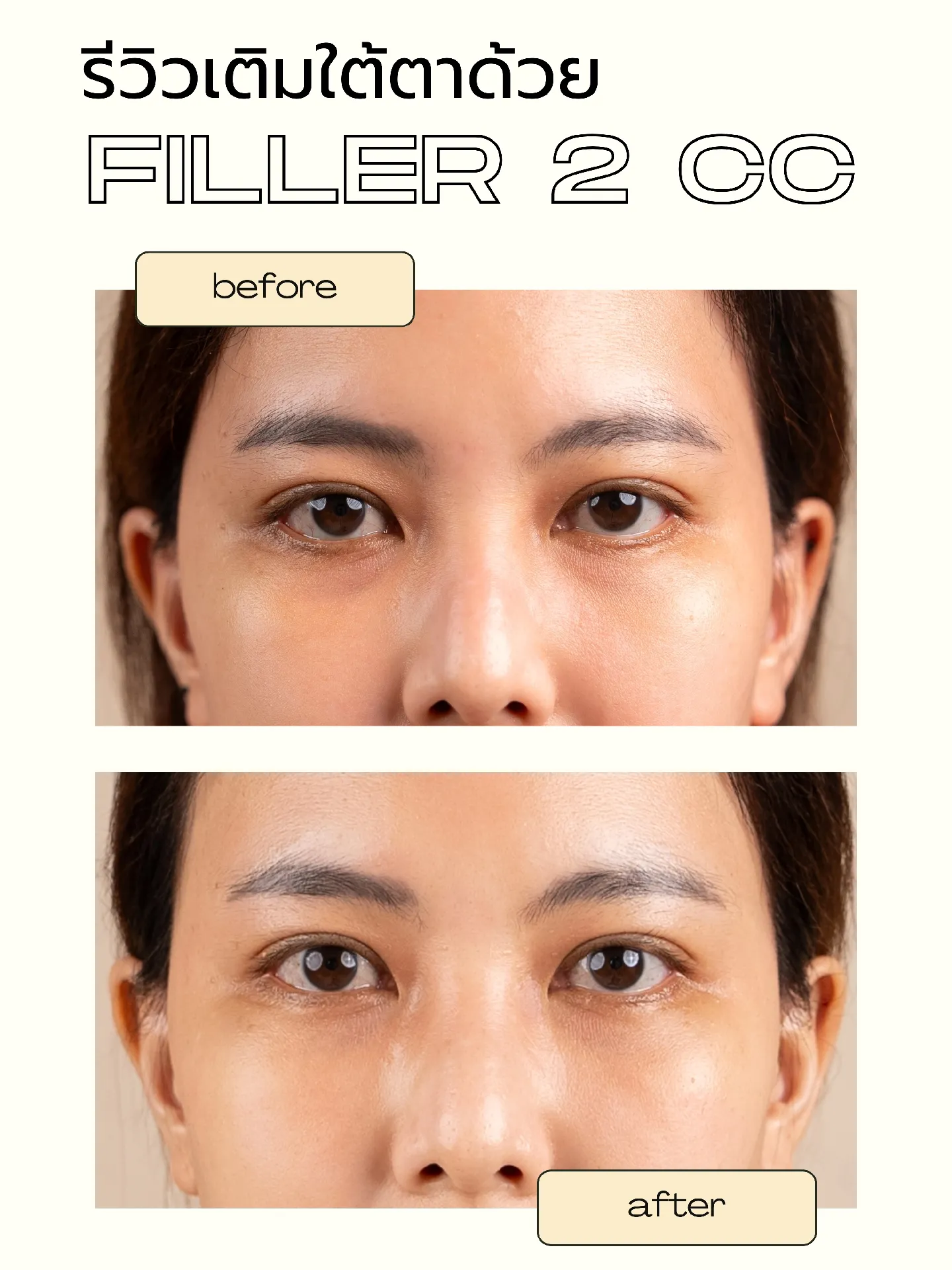 รีวิวฉีด filler ใต้ตา 2 cc | แกลเลอรีที่โพสต์โดย bbutter.is | Lemon8