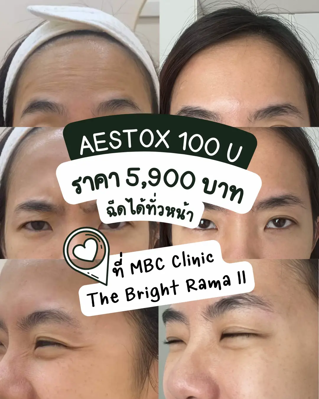 รีวิวโบทอกซ์ ริ้วรอยโนสปอน | แกลเลอรีที่โพสต์โดย Sa Thananchamon | Lemon8