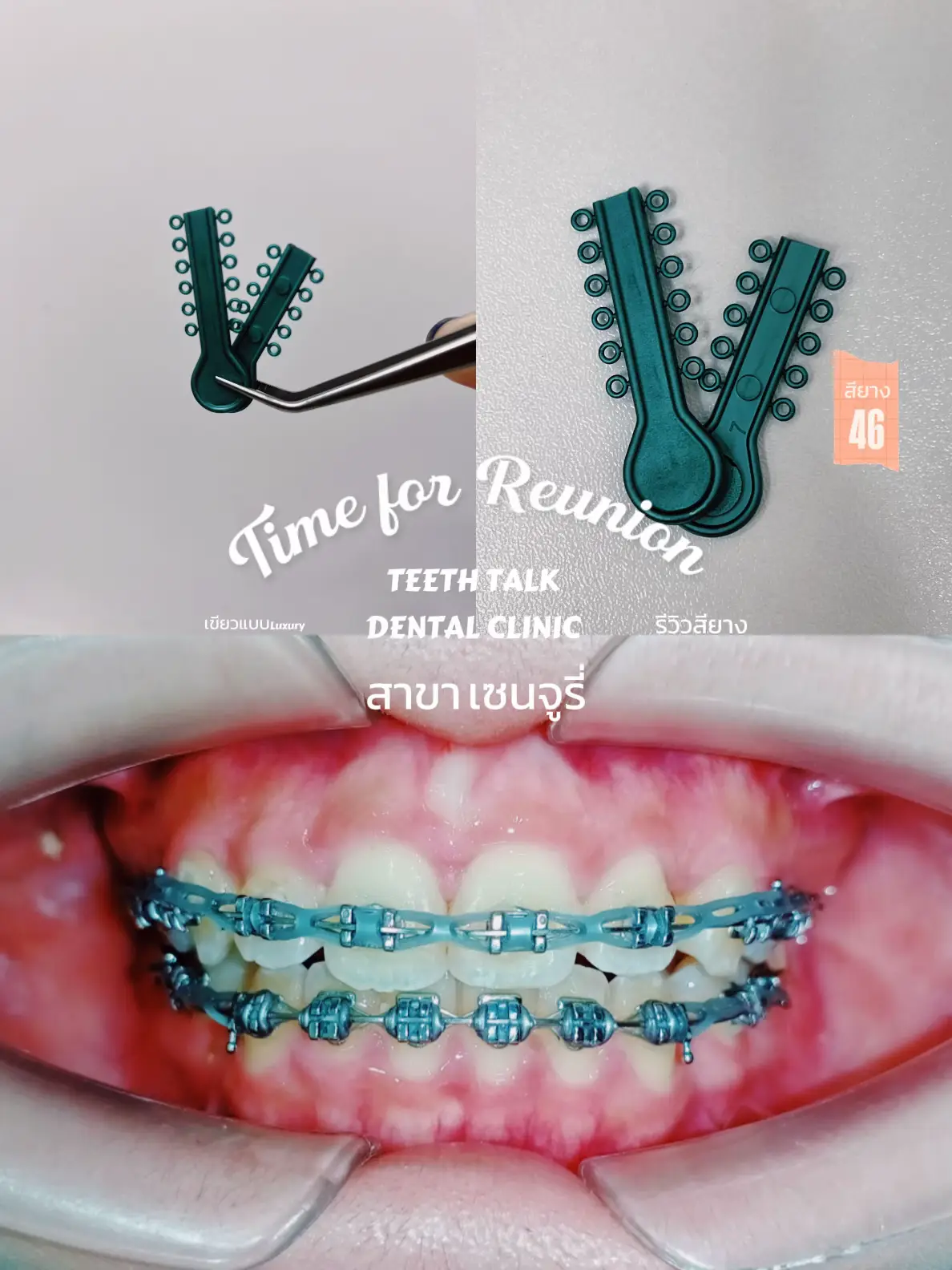 รีวิวสียาง TEETH TALK DENTAL CLINIC | แกลเลอรีที่โพสต์โดย Aoy-🫶 🌷 | Lemon8