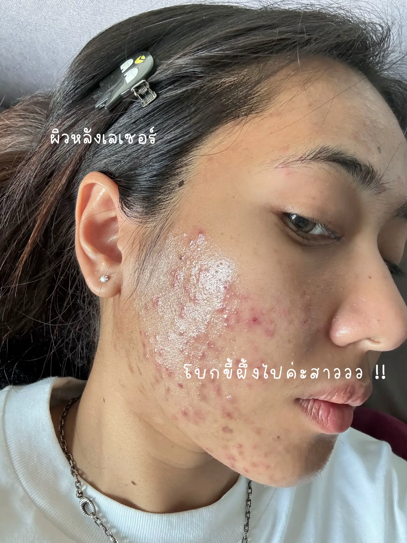 อัพเดท เข้ารักษาสิวที่พรเกษม (อีกแล้ว) !! | แกลเลอรีที่โพสต์โดย nnxpich ...