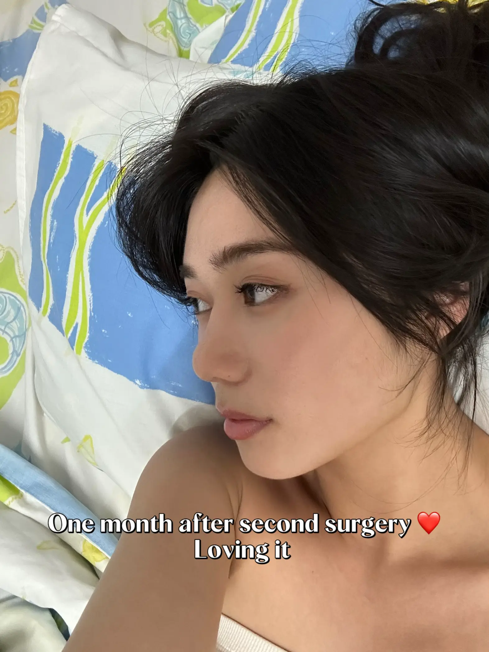 Rhinoplasty surgery 2.0 | Gallery posted by Sallest | Lemon8