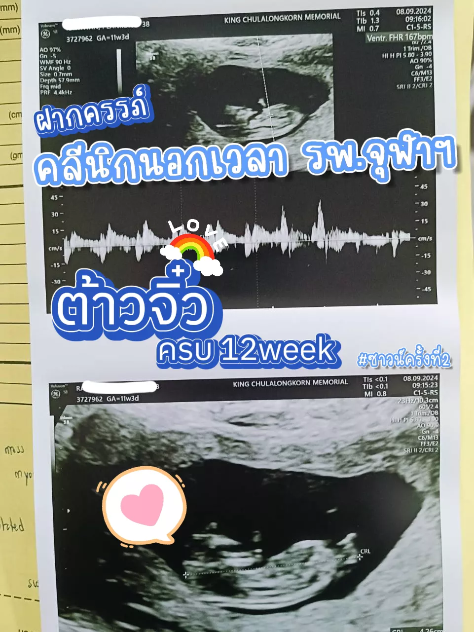 ฝากครรภ์ลูกคนแรก คลีนิกนอกเวลารพ.จุฬาฯ[2567] | แกลเลอรีที่โพสต์โดย PPHome&2Cats. | Lemon8