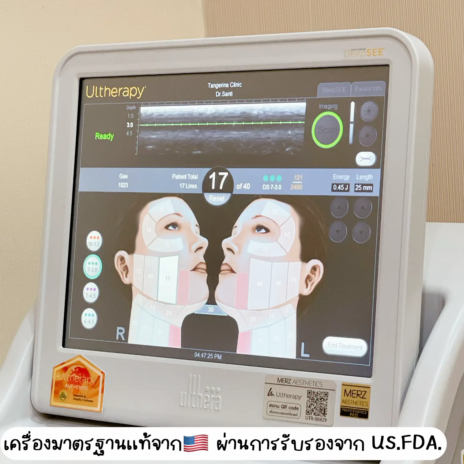 ป้ายยา ทำ Ulthera ที่ไหนยังไง ให้ได้ราคาดี๊ดีย์ 😍 | แกลเลอรีที่โพสต์โดย รีวิวจัง 彡★ | Lemon8