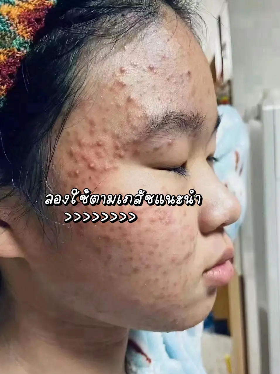 ป้ายยา CURECODE มอยส์คนเป็นสิวผิวมัน ที่คุณหมอแนะนำ! 💁🏻‍♀️ | แกลเลอรีที่โพสต์โดย Chanan🍅🥦 | Lemon8