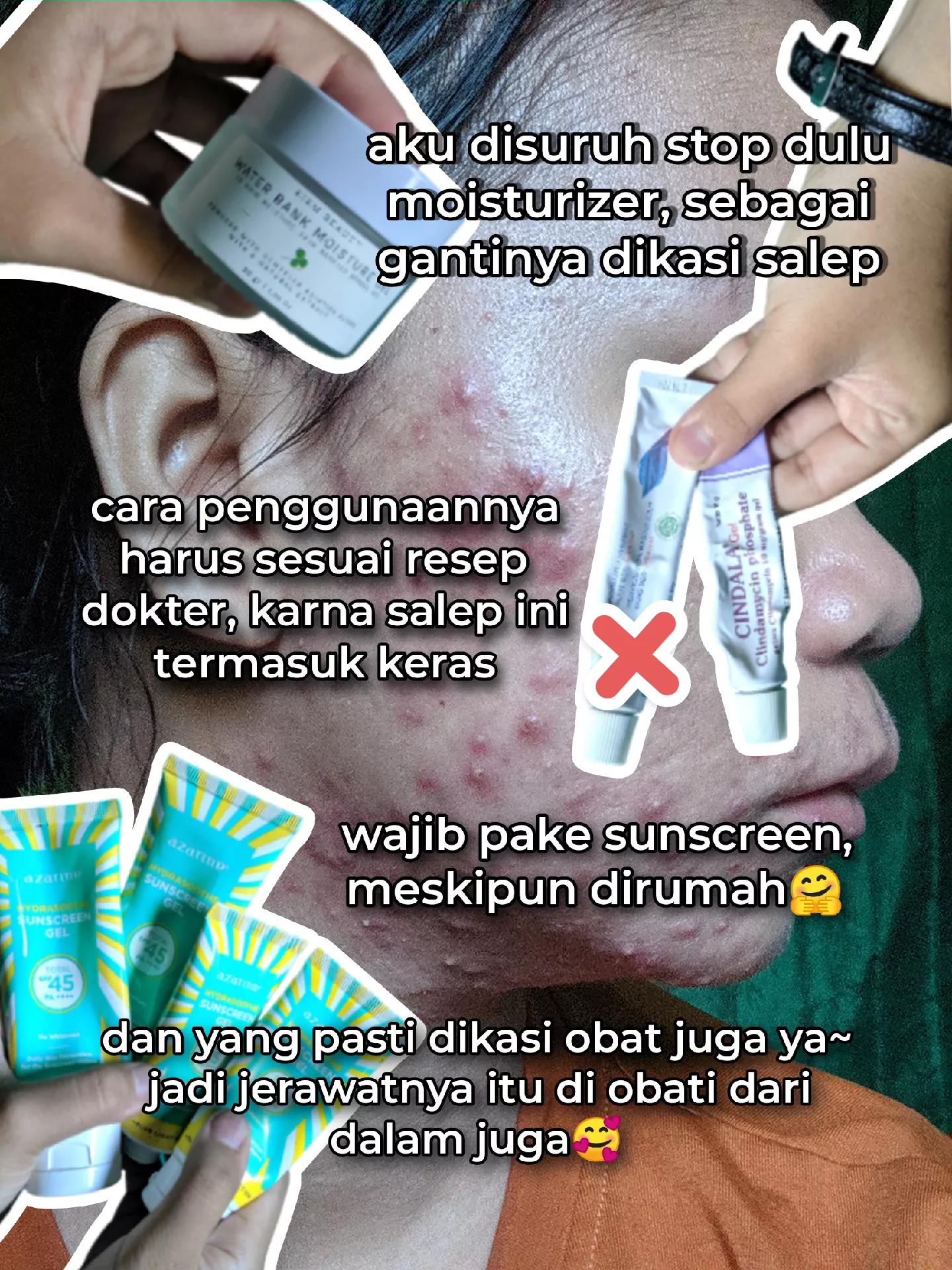 CARA AKU MENGATASI JERAWAT 🤗 | Galeri diposting oleh arin | Lemon8