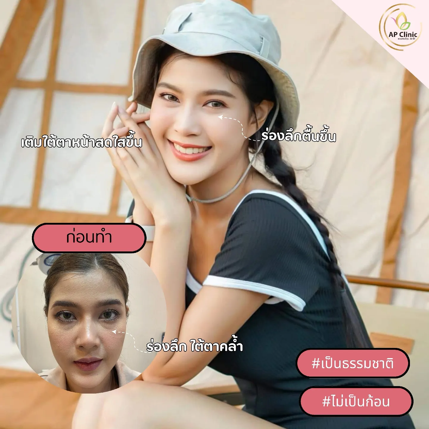 ฟิลเลอร์ใต้ตาคล้ำ | แกลเลอรีที่โพสต์โดย Waraphon Rueang | Lemon8