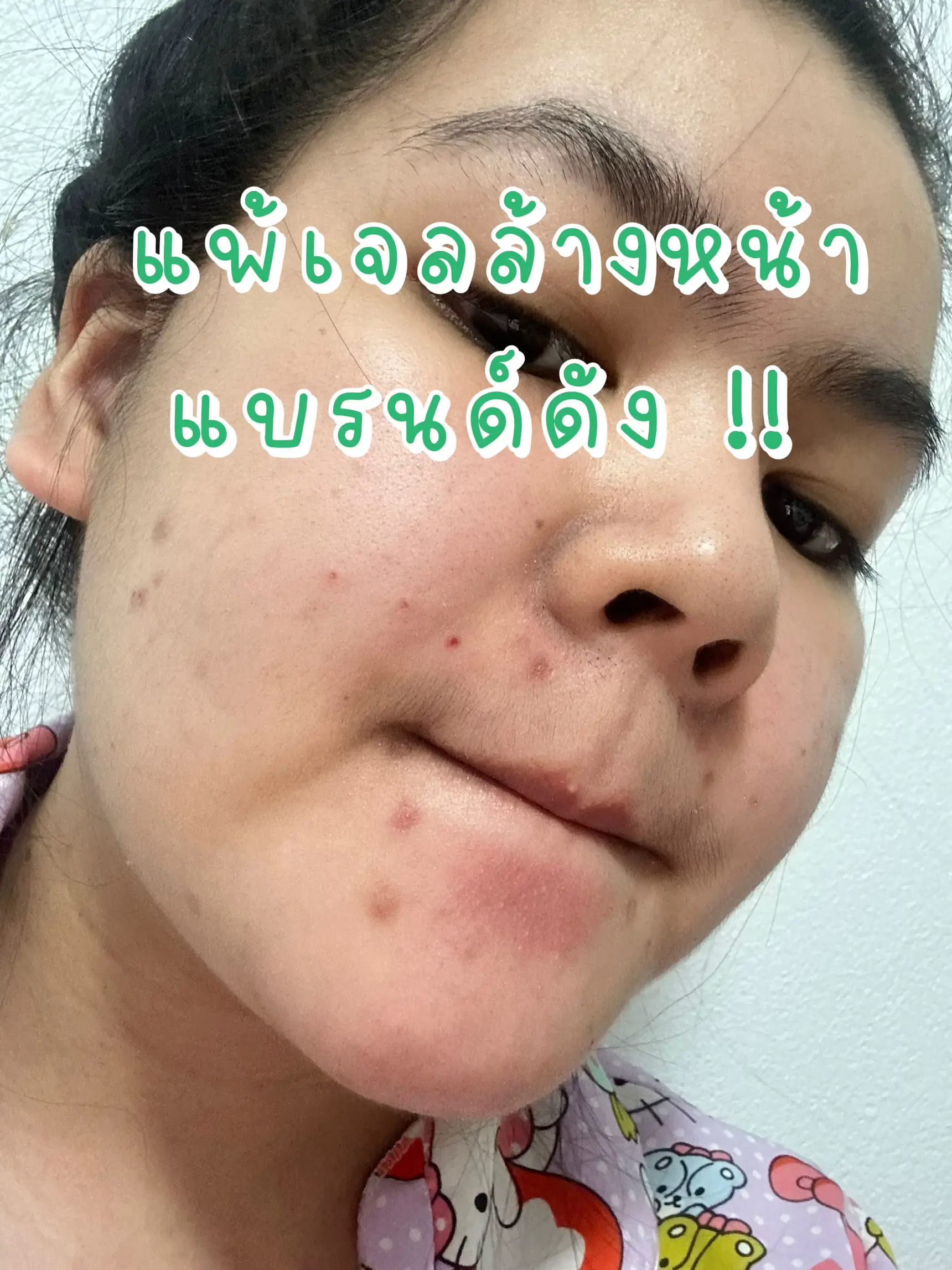 แพ้เจลล้างหน้าแบรนด์ดัง ขวดสีเขียว !! | แกลเลอรีที่โพสต์โดย ♡ PREEYA ♡ | Lemon8