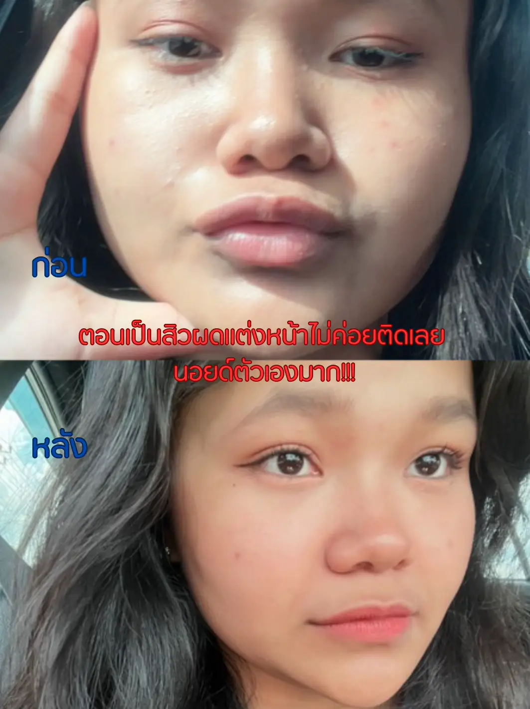 แชร์เคล็ด(ไม่)ลับรักษาสิวผด,สิวอักเสบ ภายใน3วัน! | แกลเลอรีที่โพสต์โดย ...