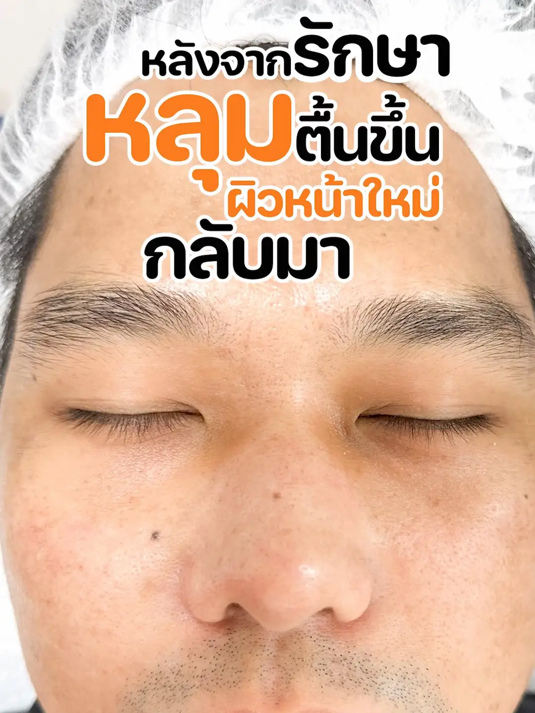 อยากได้ผิวหน้าใหม่ ให้มาที่นี่.. | วิดีโอที่เผยแพร่โดย Dr.Ploy รุ่งนภา | Lemon8