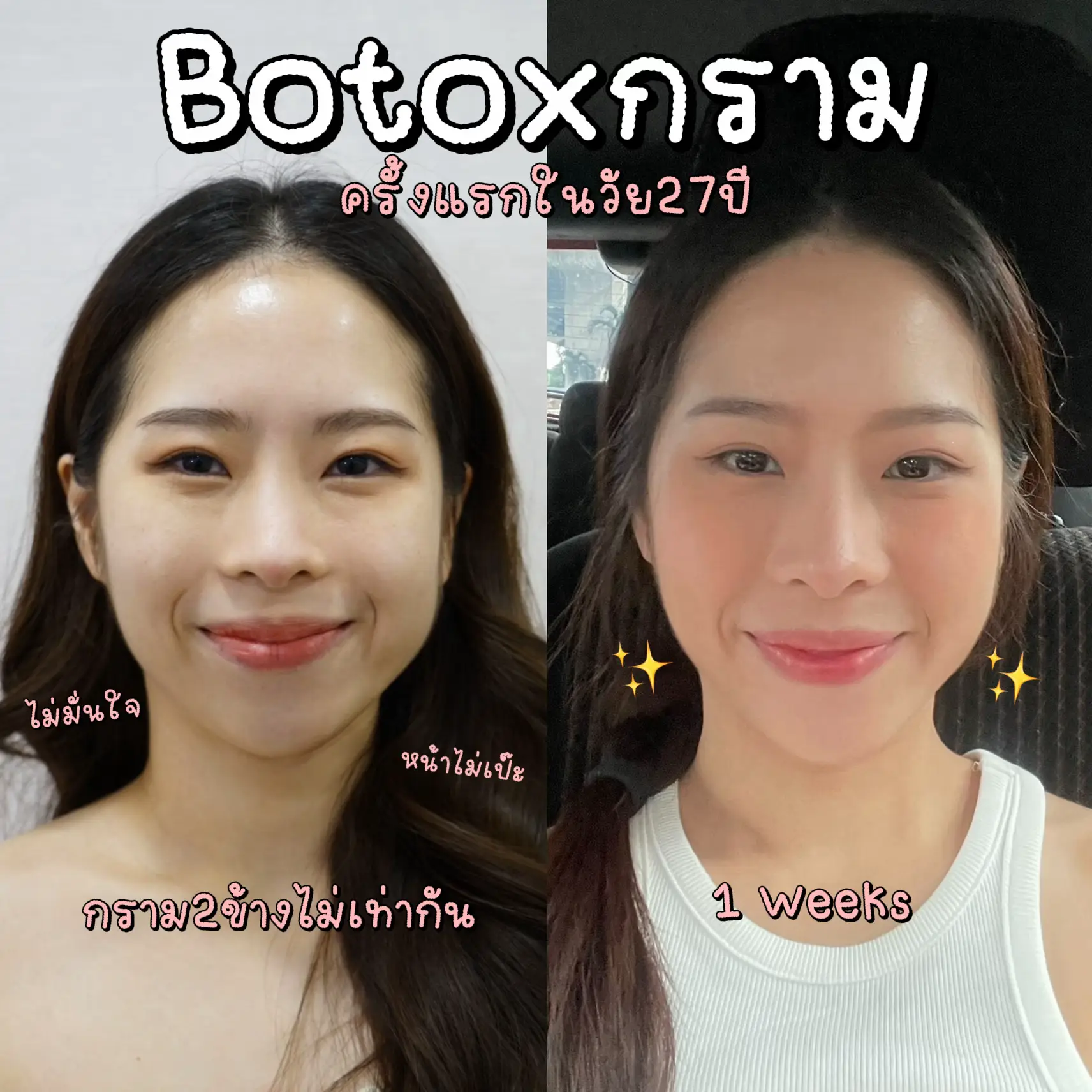 Review Botoxกรามครั้งแรก ฉบับคนกรามไม่เท่ากัน💉 | แกลเลอรีที่โพสต์โดย Cartoonct | Lemon8