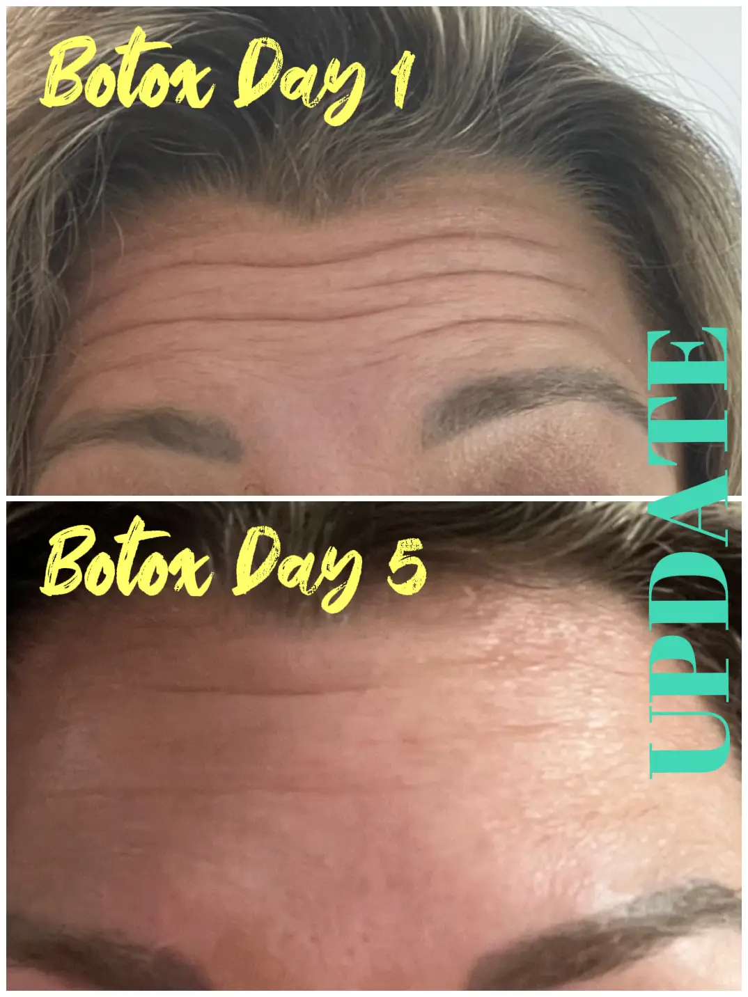 Botox Day 1 | Gallery posted by Marisa A | Lemon8