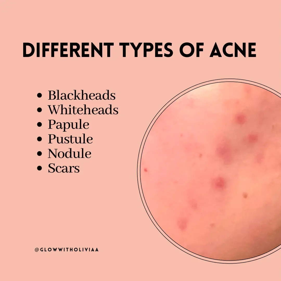Different kinds of acne and how to treat | Galeri disiarkan oleh Glowwitholiviaa | Lemon8