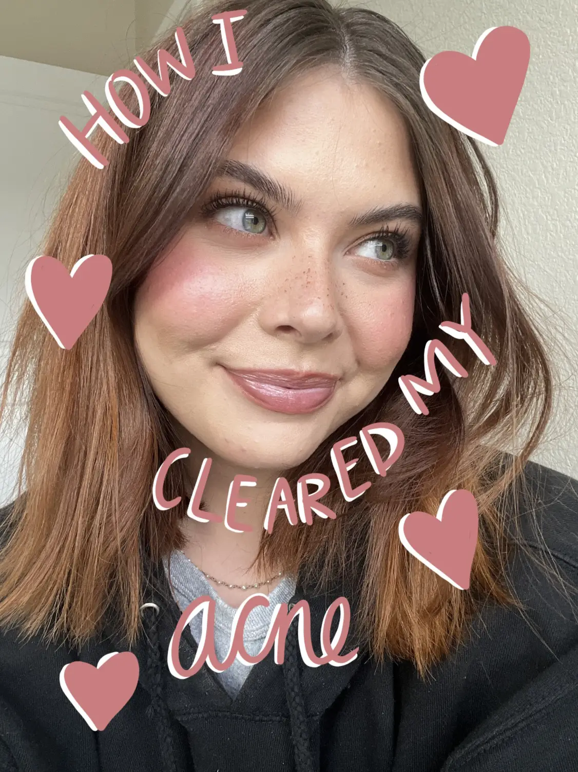 products that helped me clear my acne! | แกลเลอรีที่โพสต์โดย ...