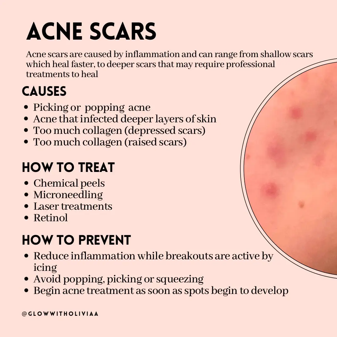 Different kinds of acne and how to treat | Galeri disiarkan oleh Glowwitholiviaa | Lemon8