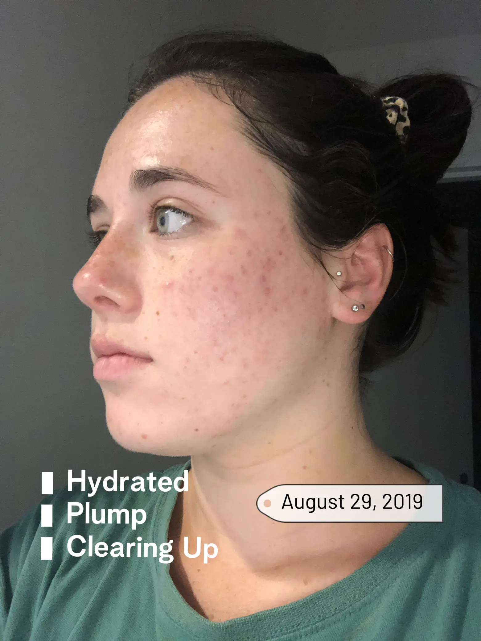 My skin transformation🙈 | Gallery posted by Ally Swartz | Lemon8
