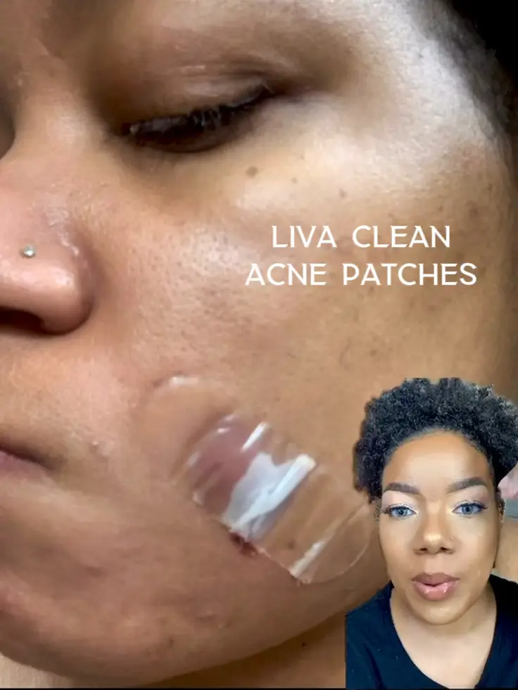 Acne fighting patches | Video published by Beatbabebeauty | Lemon8
