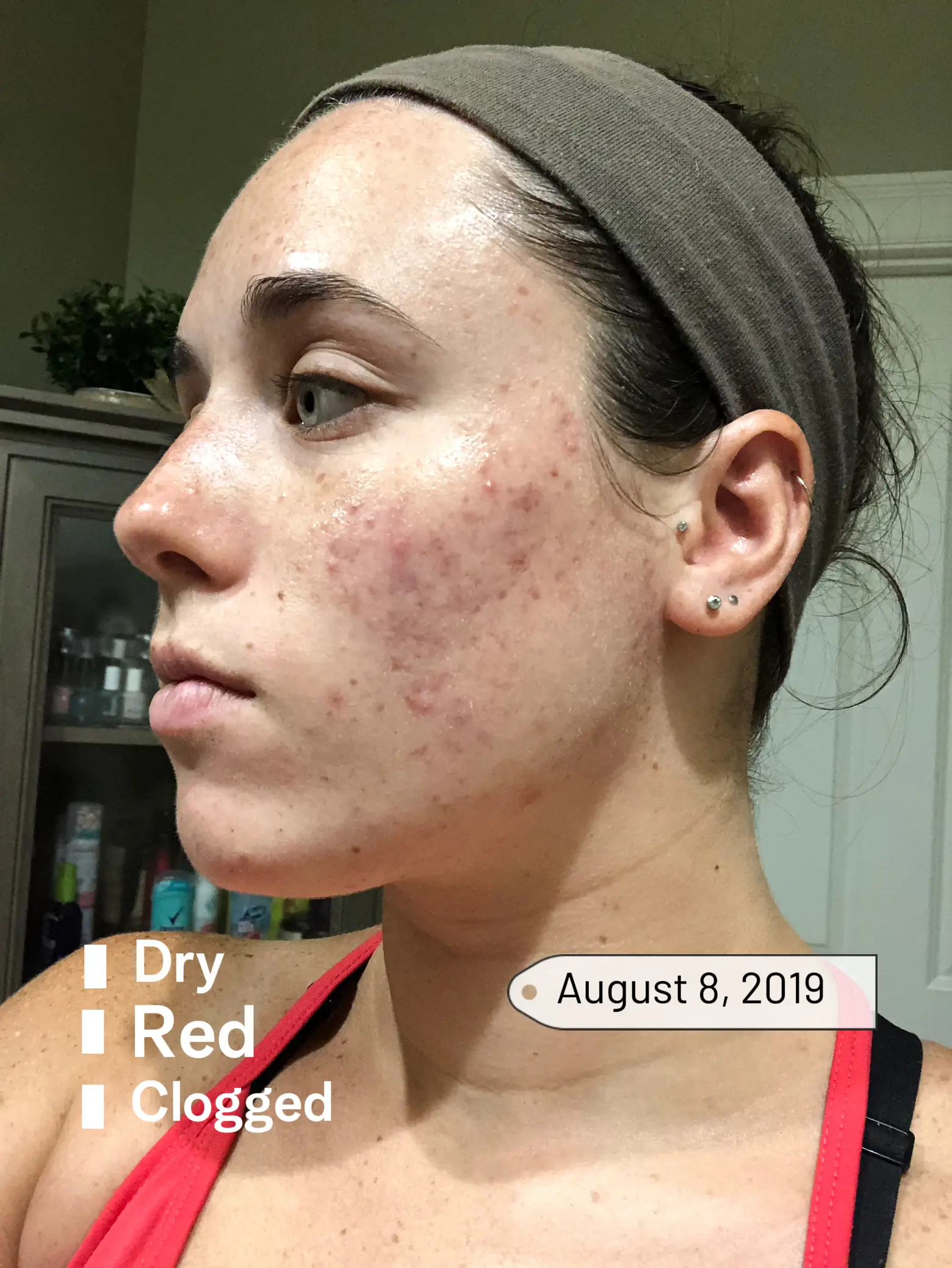 My skin transformation🙈 | Gallery posted by Ally Swartz | Lemon8