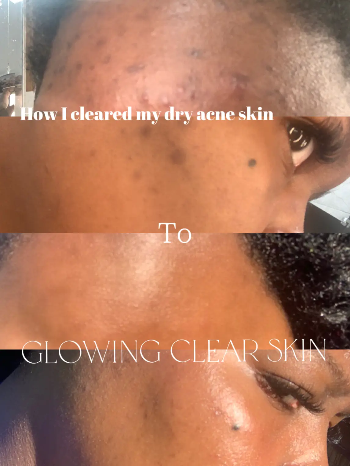 Tips for having dry acne skin | แกลเลอรีที่โพสต์โดย Sas C Beauty | Lemon8