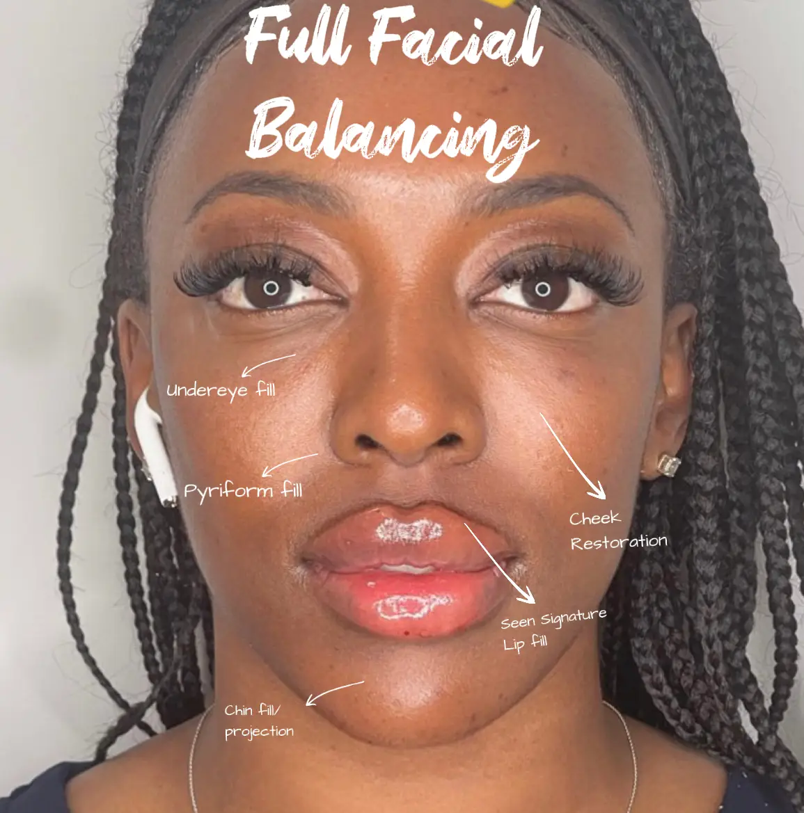 Full Facial Balancing | Gallery posted by Nurse Mariam | Lemon8
