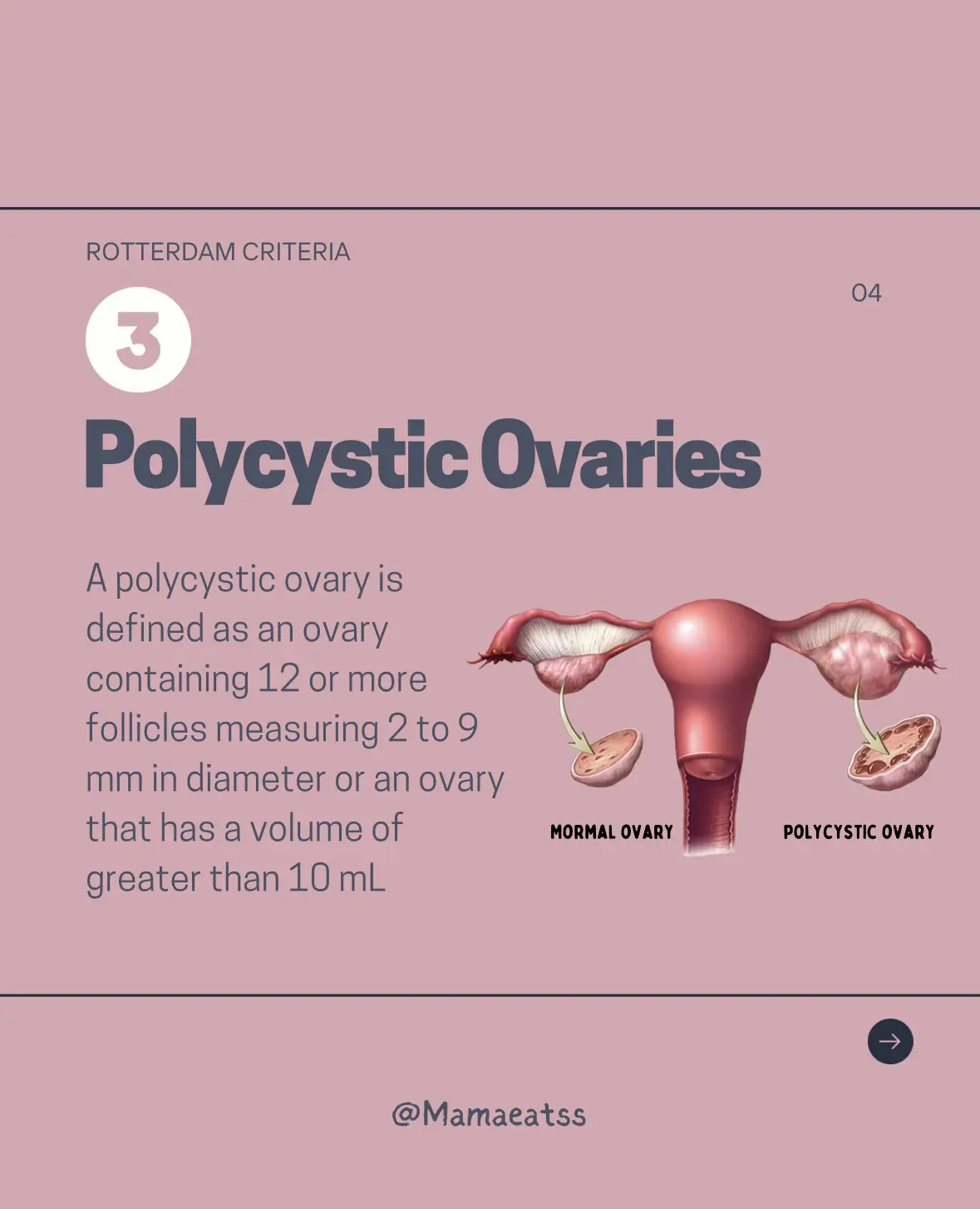 PCOS is the leading cause of infertility. | Gallery posted by Meghan ...
