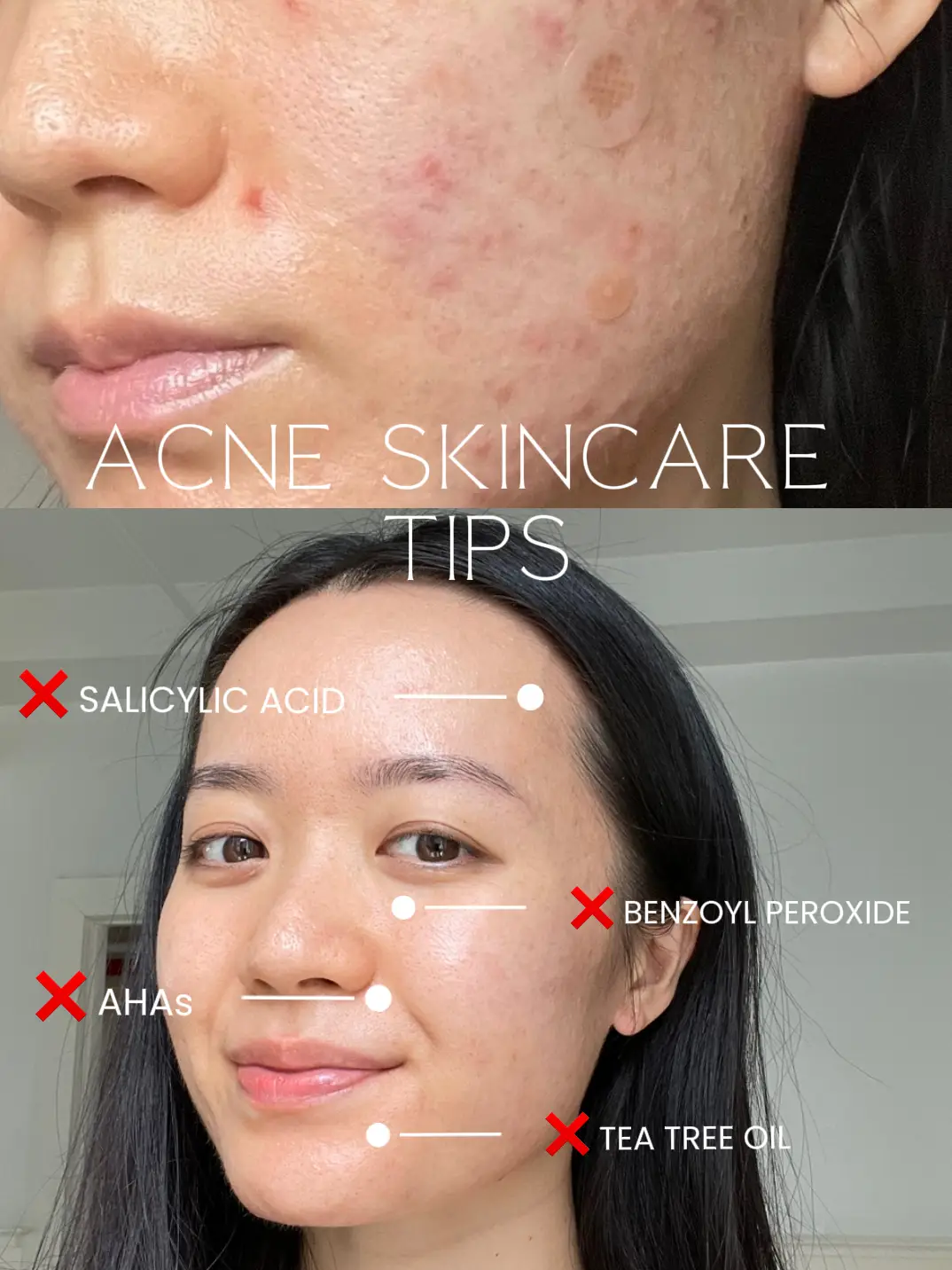 Acne skincare tips | Gallery posted by TIFFANY C ♡ | Lemon8