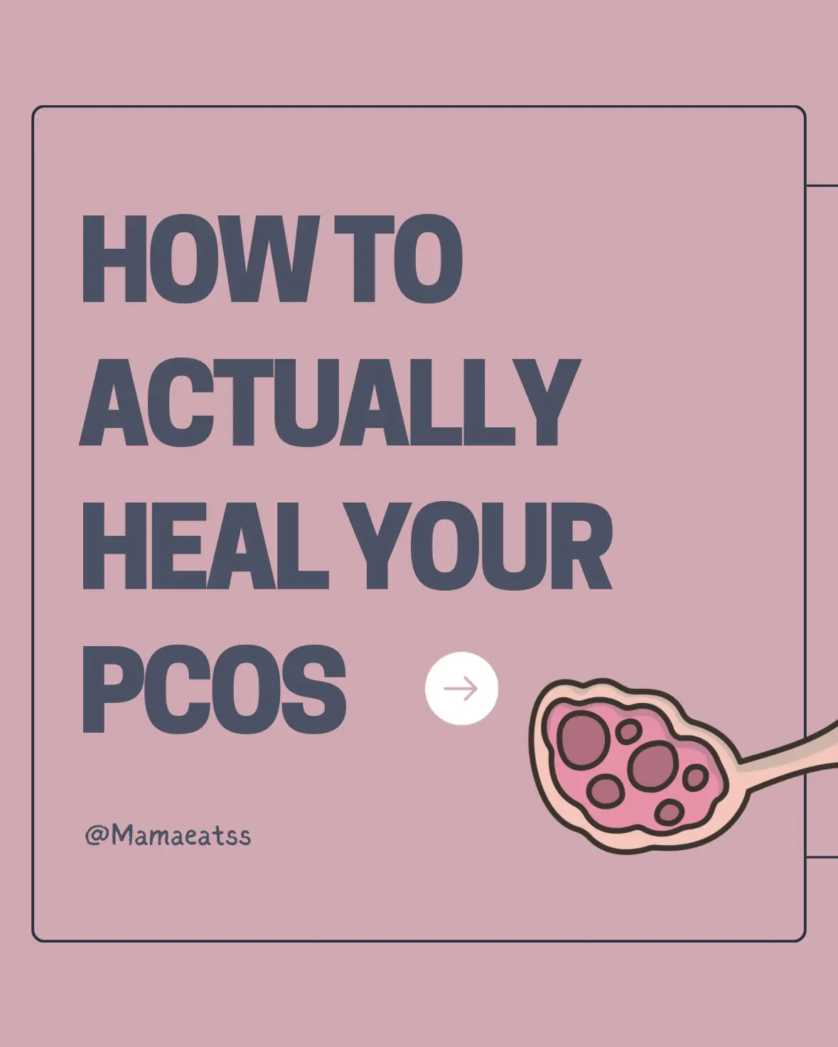PCOS is the leading cause of infertility. | Gallery posted by Meghan ...