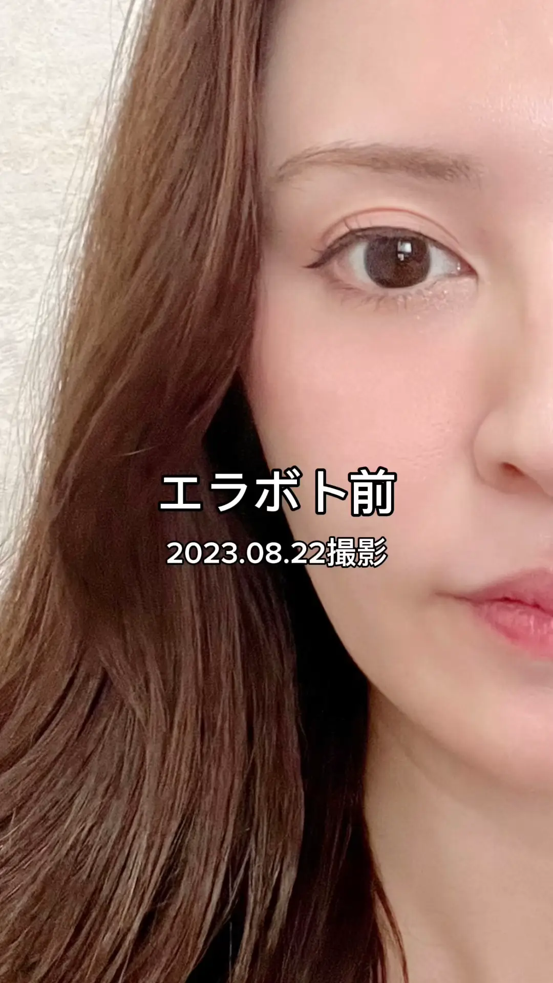 糸リフトなしでエラ綺麗になった | shiho💍オイリー女美容の投稿動画 | Lemon8