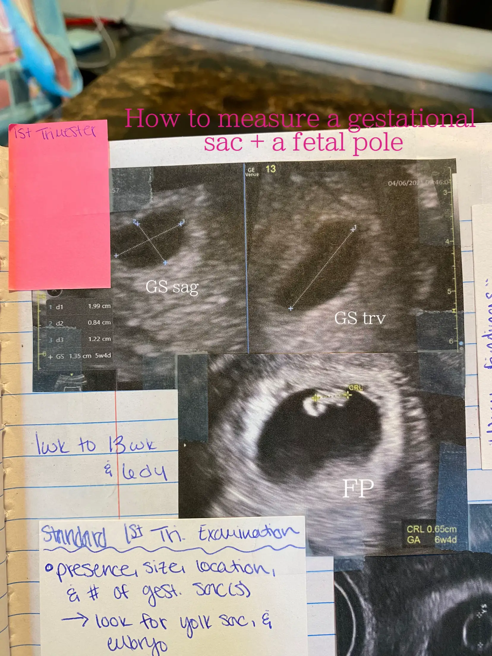 1st Trimester OB Exam | Gallery posted by Ky_SonoLife | Lemon8