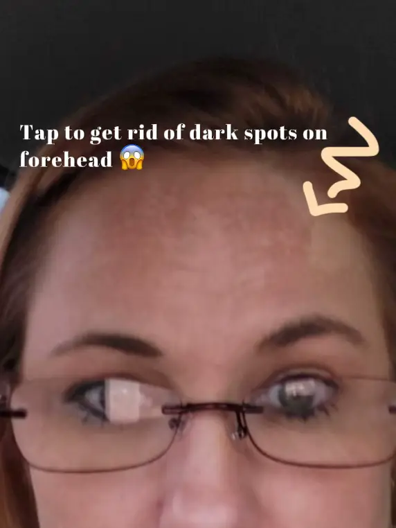 Tap to get rid of dark spots on forehead 😱 | Gallery posted by ...