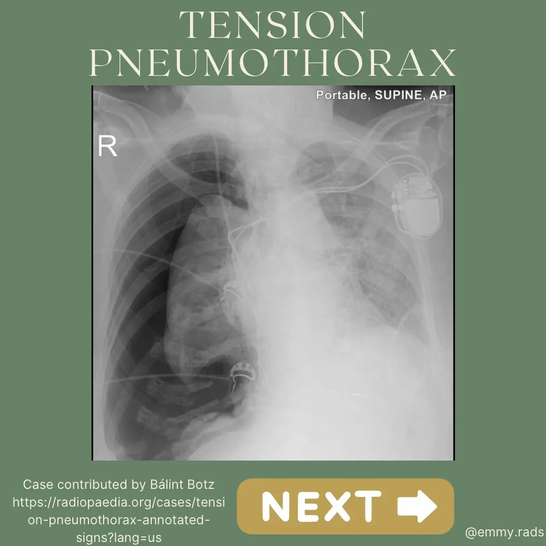 Tension Pneumothorax! 🚨🩻 | Gallery posted by Em Barnard, MD | Lemon8
