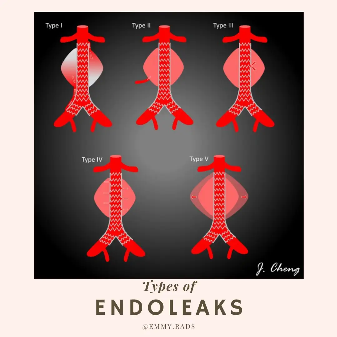Endoleaks 🩸 | Gallery posted by Em Barnard, MD | Lemon8