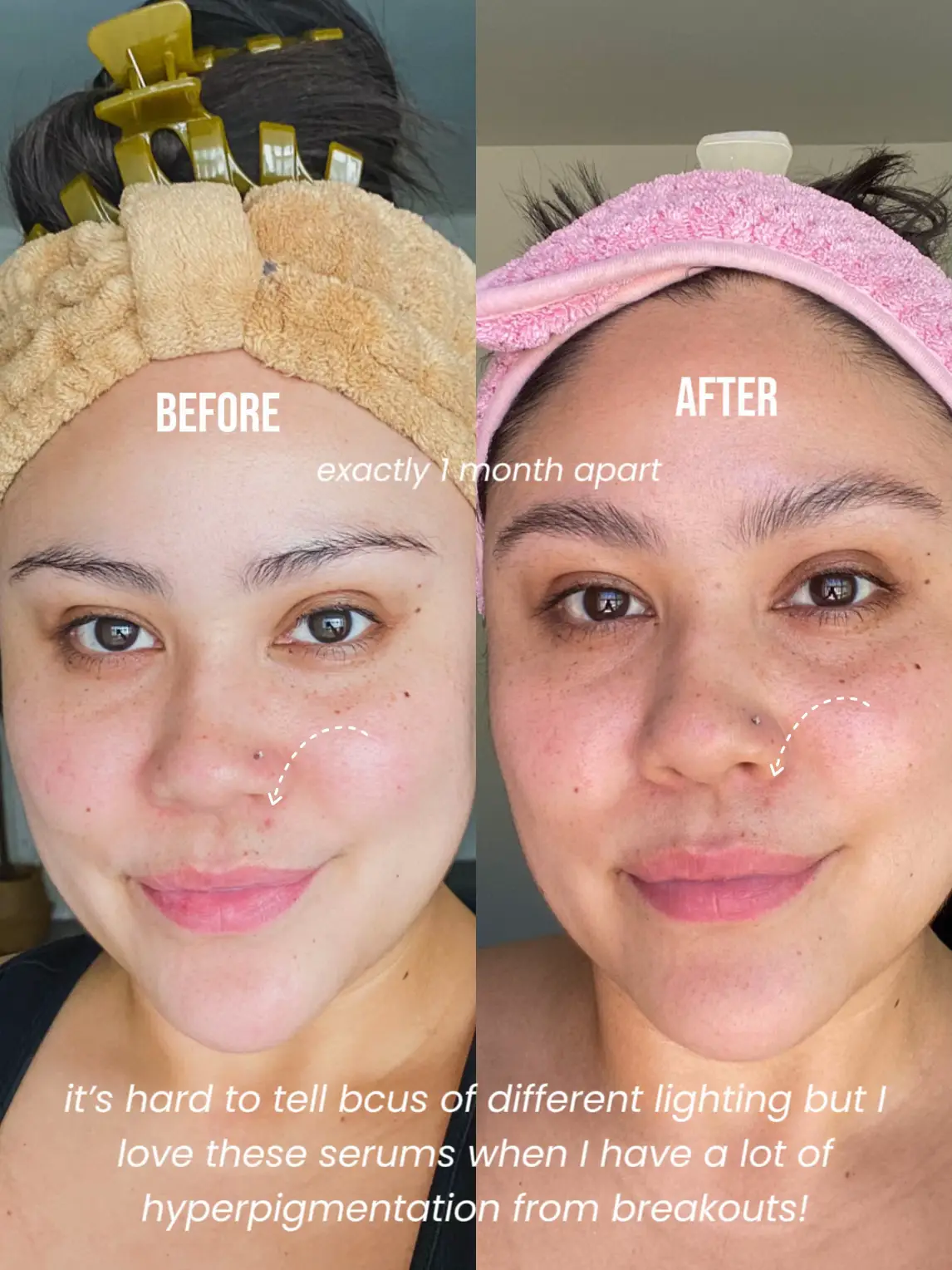 Affordable Serums for Hyperpigmentation! | Gallery posted by sarahsowse | Lemon8