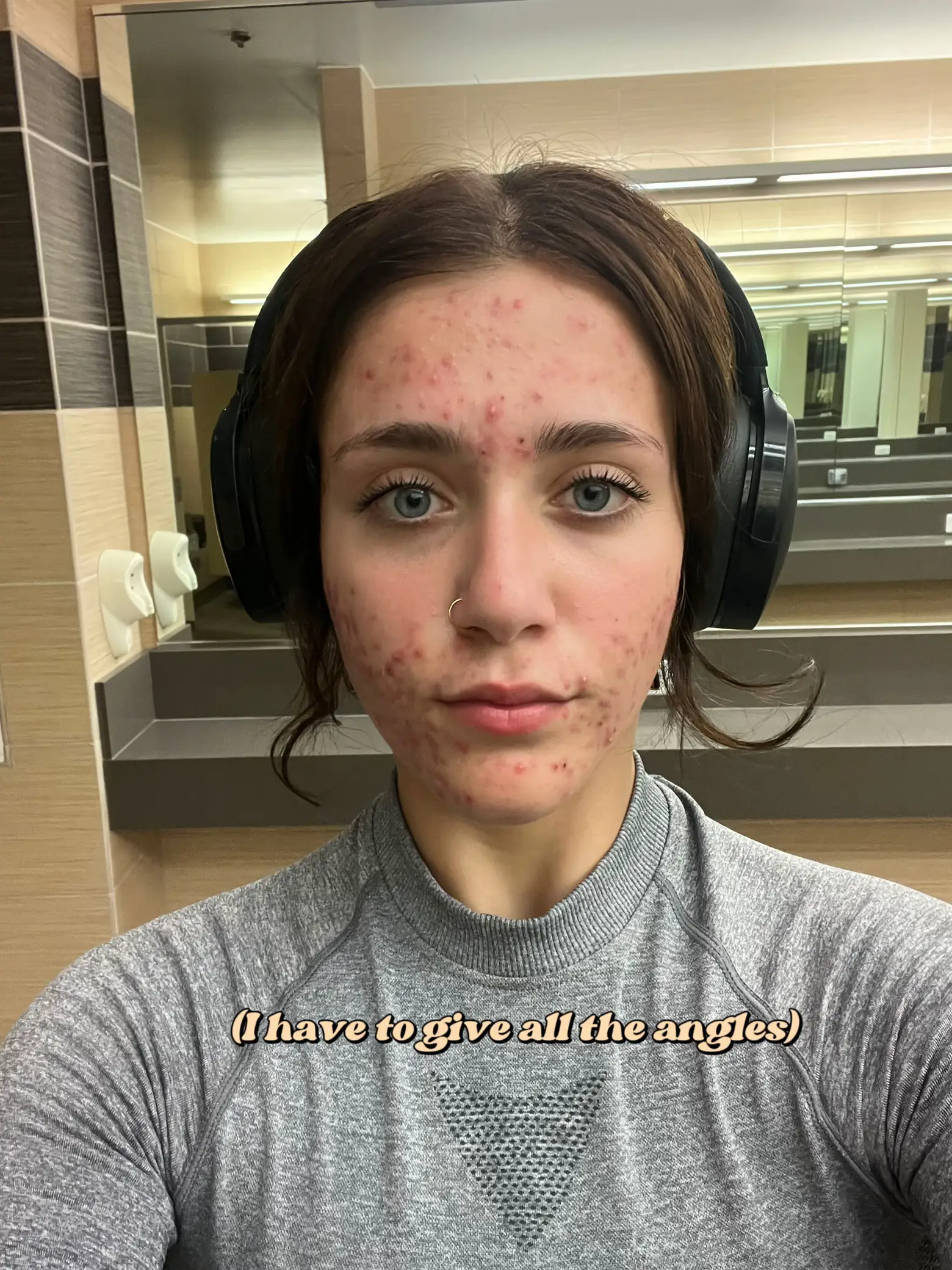 day-1-of-accutane-gallery-posted-by-octavia-lemon8
