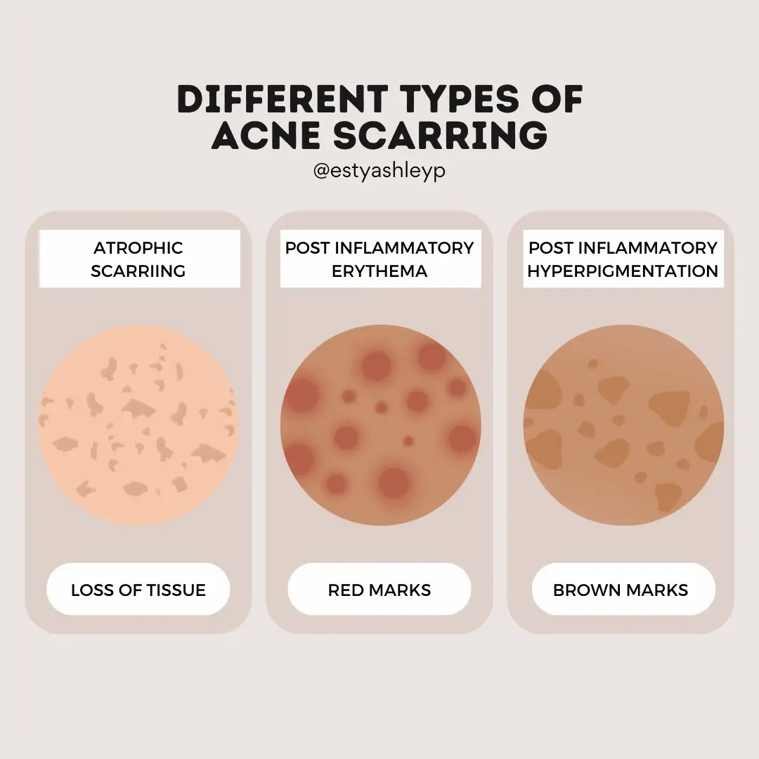 Types of Acne Scars | Gallery posted by Esty Ashley | Lemon8