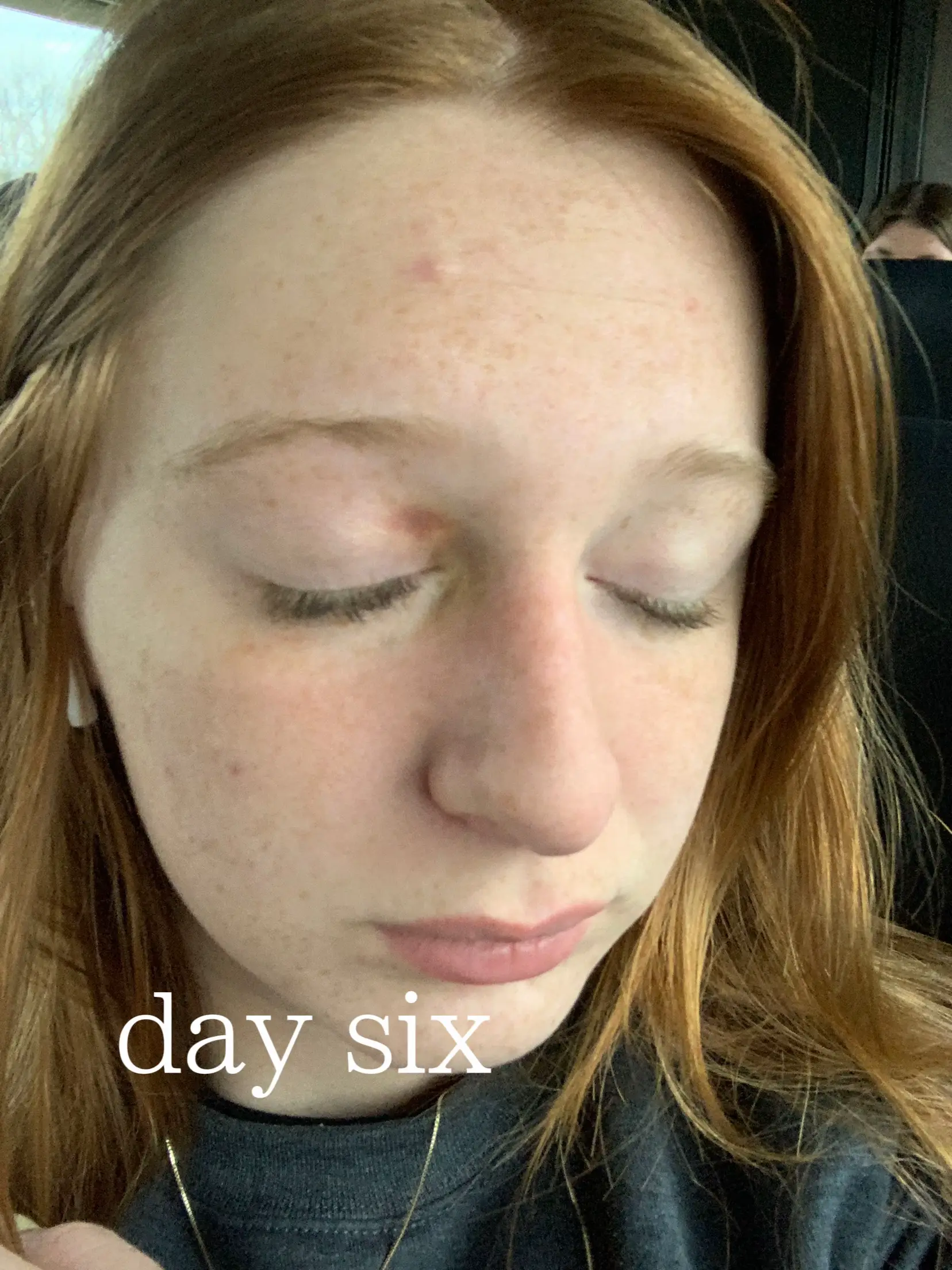 my experience getting a black-eye | แกลเลอรีที่โพสต์โดย Sav | Lemon8